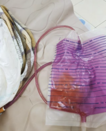 Purple urine • LITFL • Unusual Urine