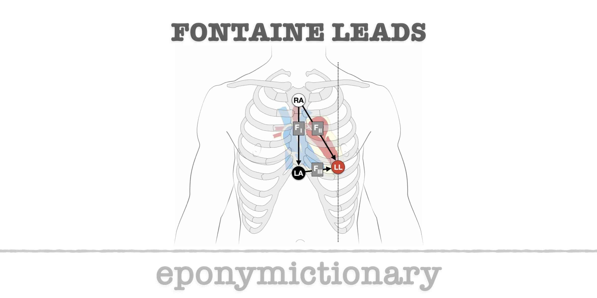 Fontaine lead • LITFL • Medical Eponym Library