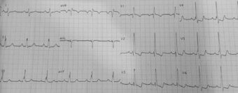 Crochetage sign • LITFL • ECG Library Diagnosis