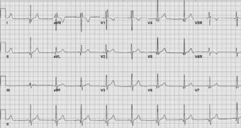 Crochetage sign • LITFL • ECG Library Diagnosis