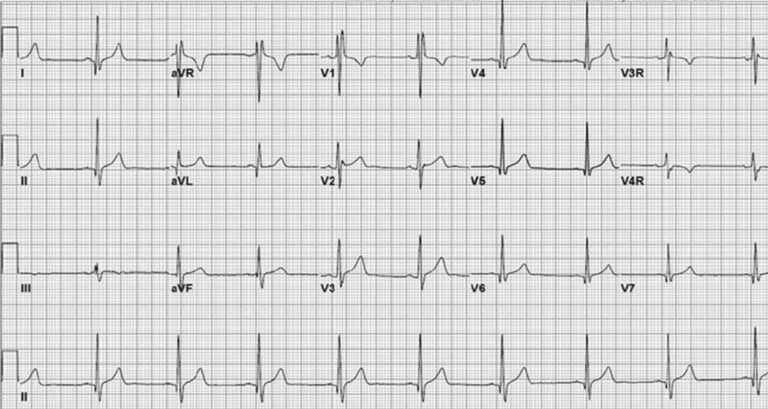 Crochetage sign • LITFL • ECG Library Diagnosis