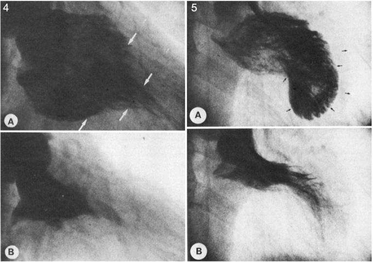 Apical hypertrophic cardiomyopathy (AHC) • LITFL • ECG Library