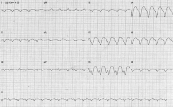 Epsilon Wave • LITFL Medical Blog • ECG Library Basics