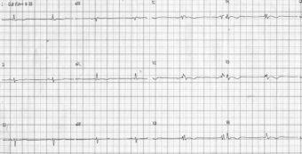 Fontaine lead • LITFL • Medical Eponym Library