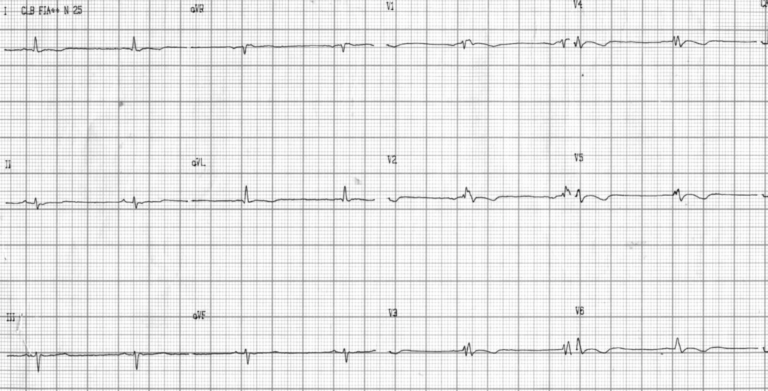 Epsilon Wave • LITFL Medical Blog • ECG Library Basics