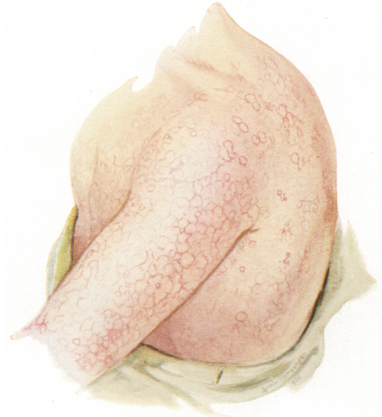 Fifth disease • LITFL • Medical Eponym Library