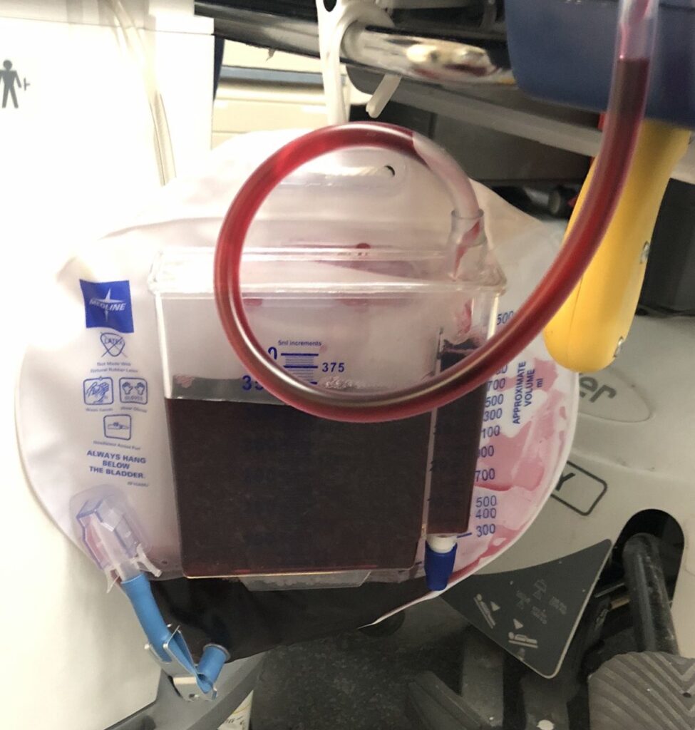 Cherry Red or Raspberry urine • LITFL • Unusual Urine