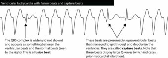 VT versus SVT: It's as easy as ABCDE • LITFL • ECG Library