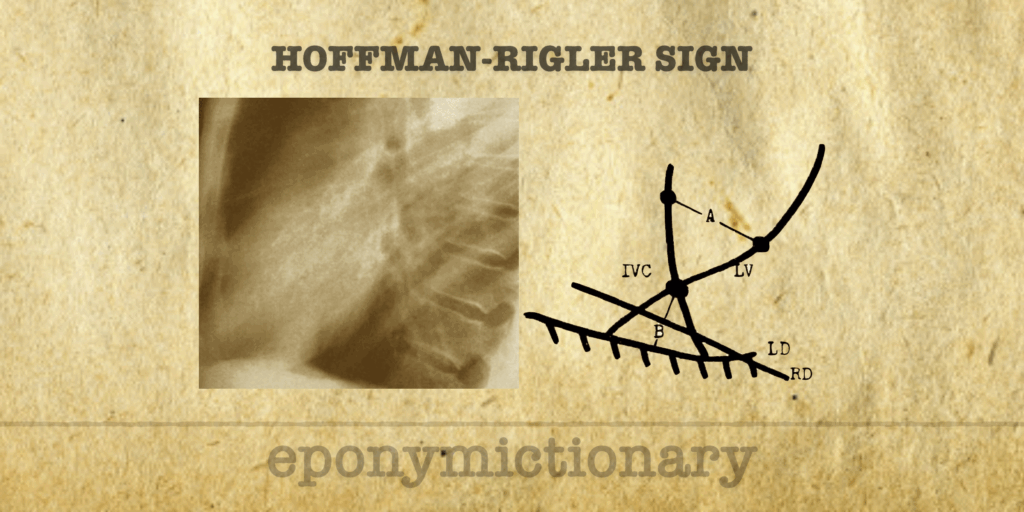 Hoffman-Rigler sign • LITFL • Medical Eponym Library