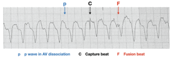 VT versus SVT: It's as easy as ABCDE • LITFL