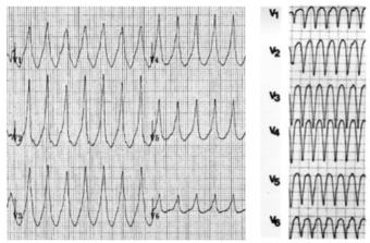 VT versus SVT: It's as easy as ABCDE • LITFL