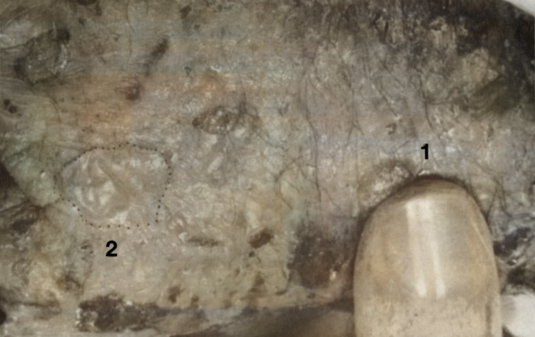 Gustav Asboe-Hansen • LITFL • Medical Eponym Library