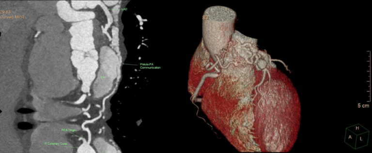 Heart HQ: Coronary Artery Anomalies • LITFL • Podcast
