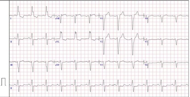 Heart HQ: Left Bundle Branch Block • LITFL • Podcast