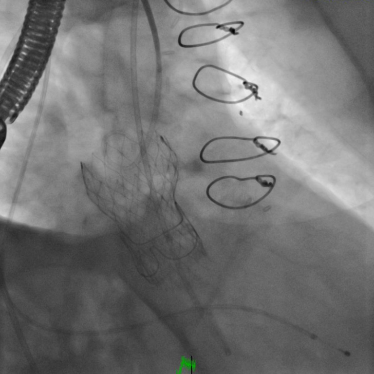 Heart HQ: Valve-in-Valve TAVI • LITFL • Podcast