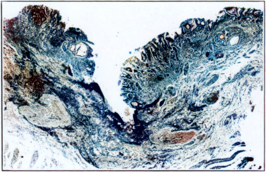 Mallory-Weiss syndrome • LITFL • Medical Eponym Library