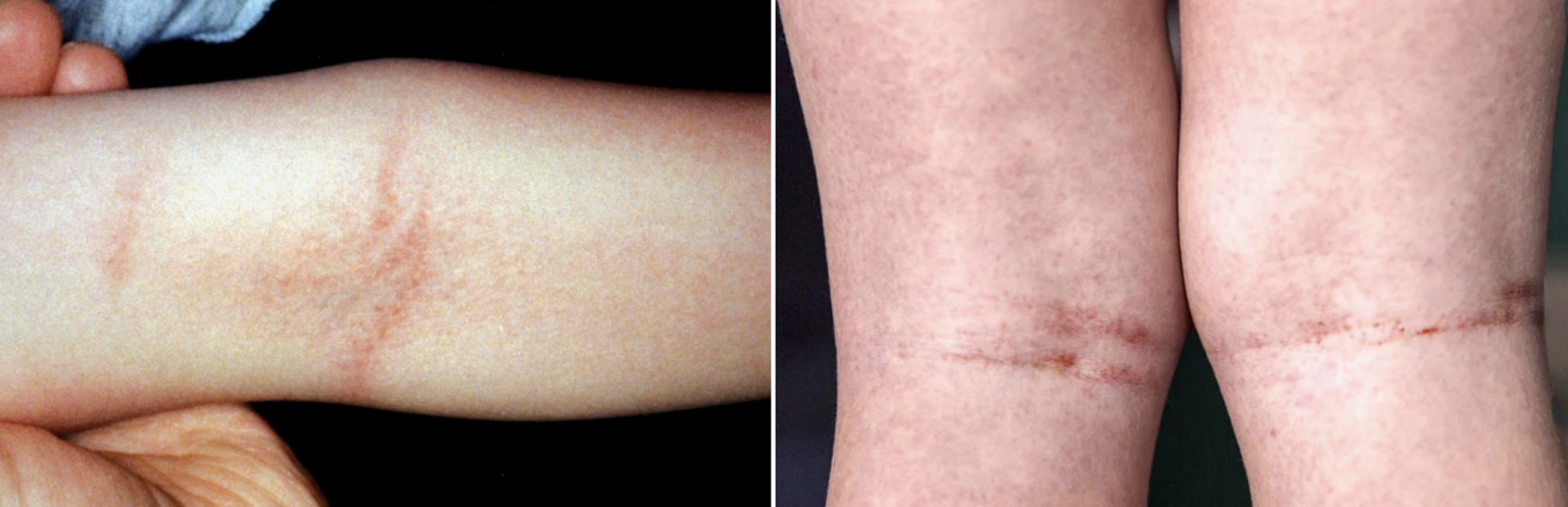 Second disease • LITFL • Medical Eponym Library