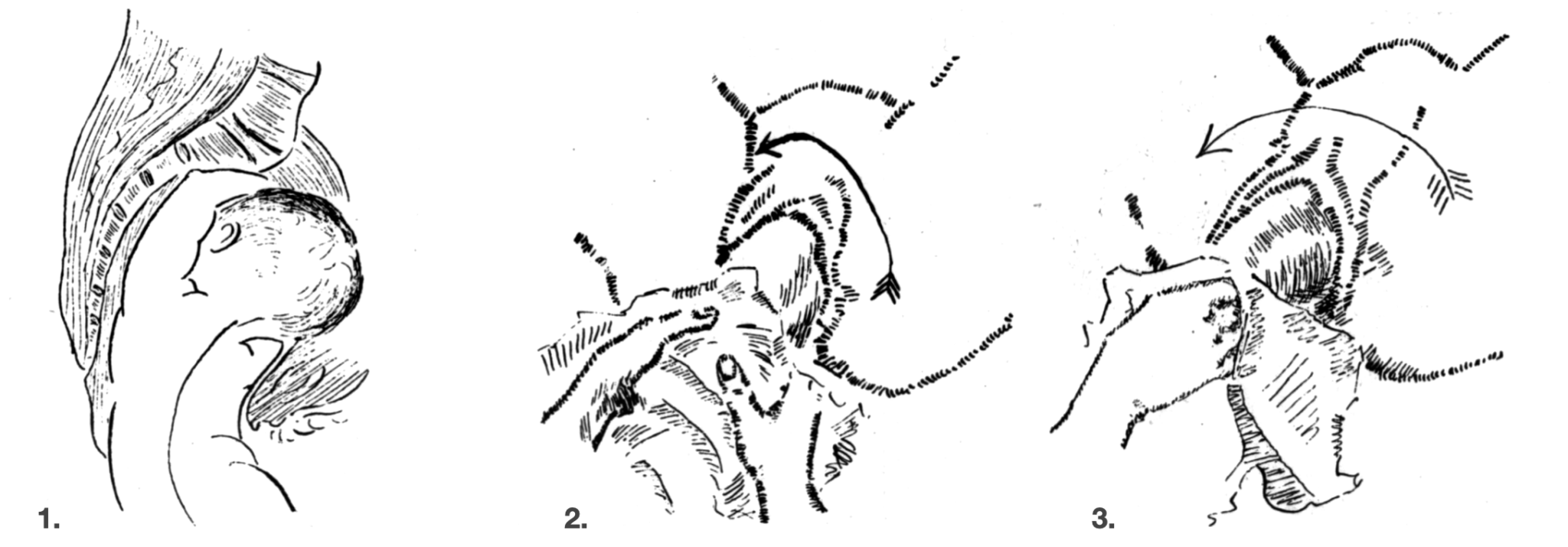 Jørgen Løvset • LITFL • Medical Eponym Library