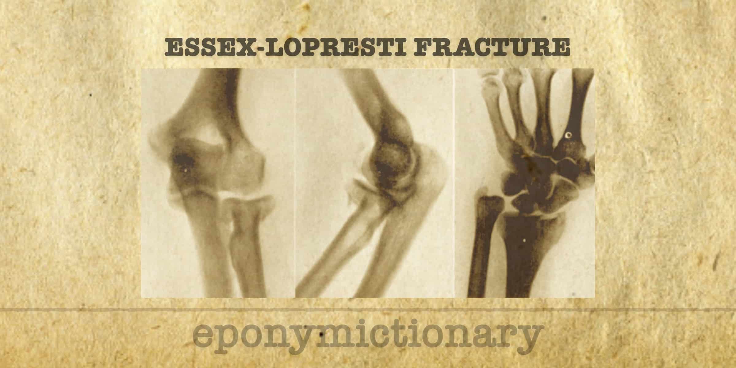 Essex-Lopresti fracture • LITFL • Medical Eponym Library