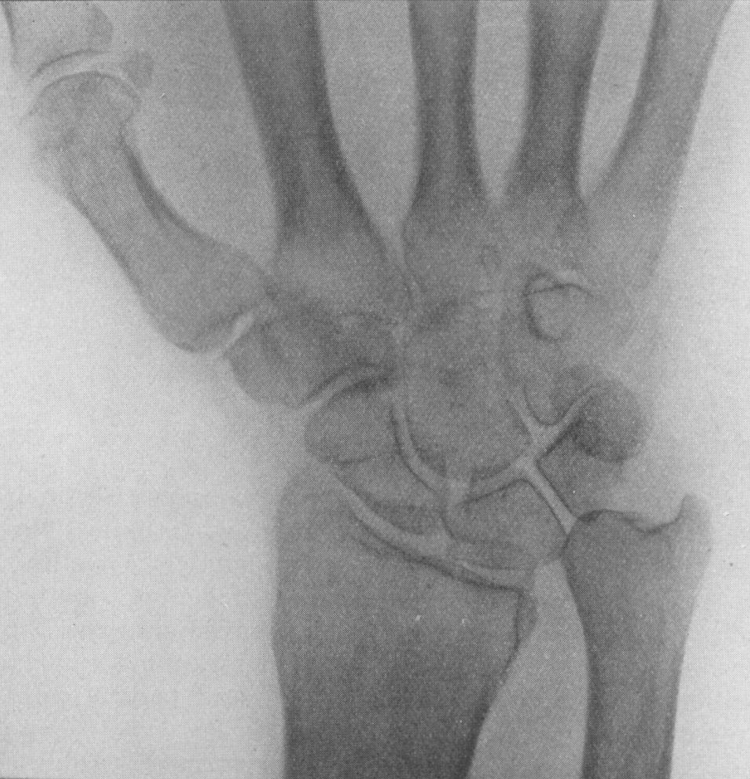 Essex-Lopresti fracture • LITFL • Medical Eponym Library
