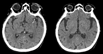 CT Case 005 • LITFL • CT scan interpretation