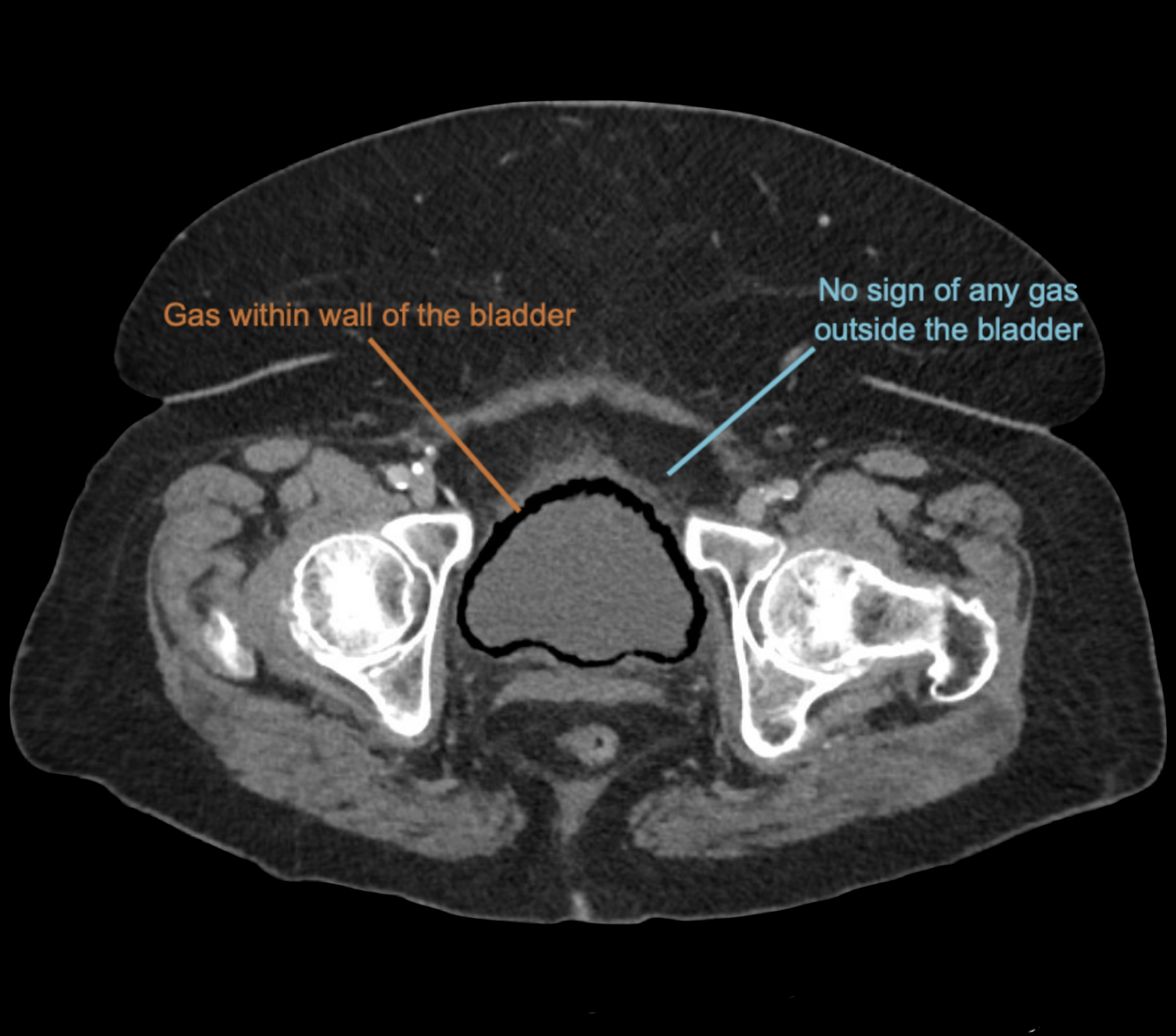 CT Case 015 • LITFL • CT scan interpretation