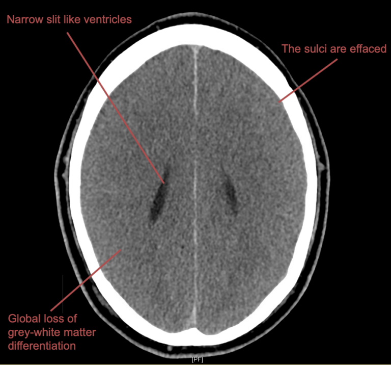 CT Case 011 • LITFL • CT scan interpretation