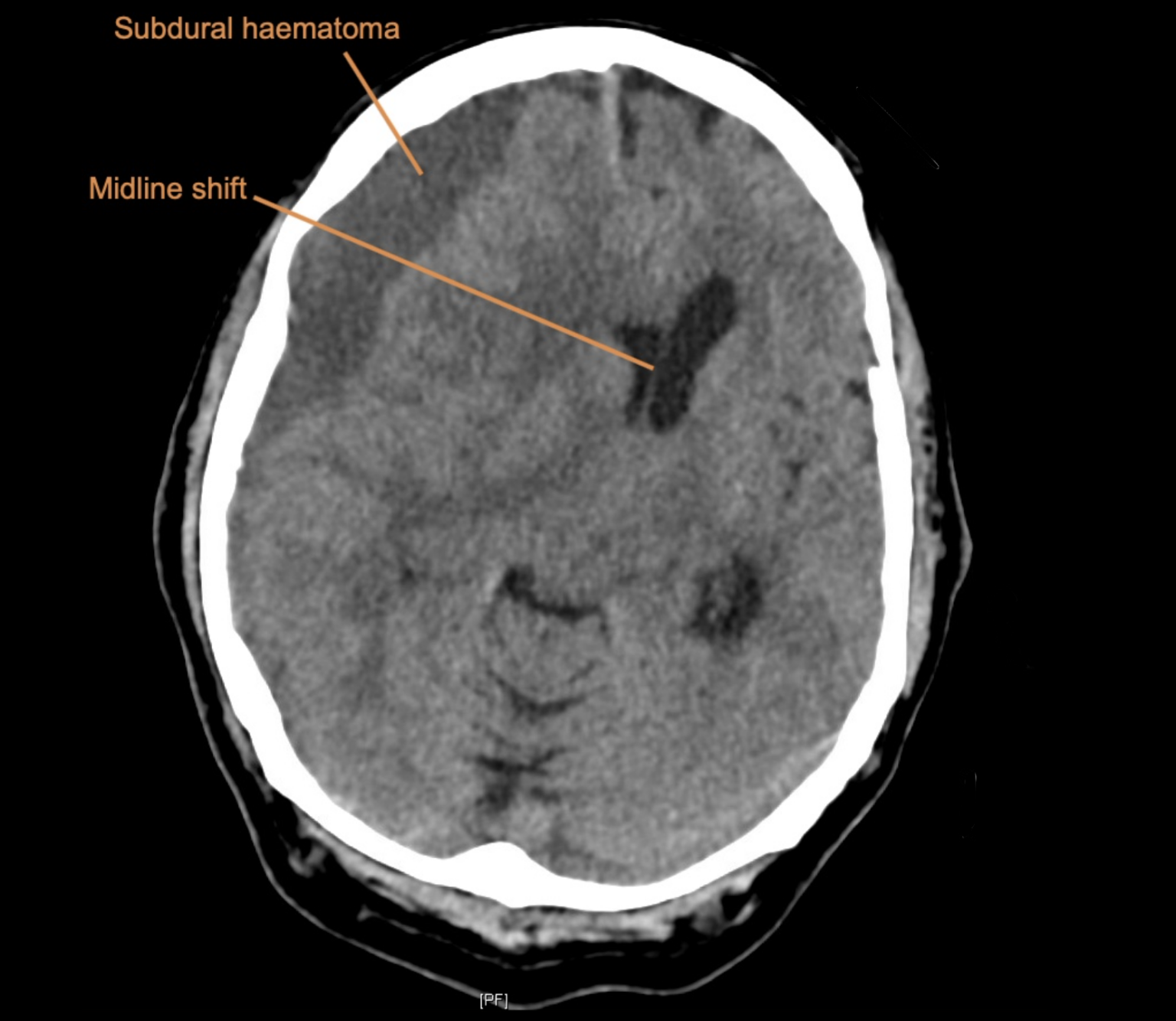 CT Case 013 • LITFL • CT scan interpretation