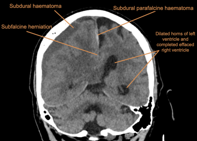 CT Case 013 • LITFL • CT scan interpretation