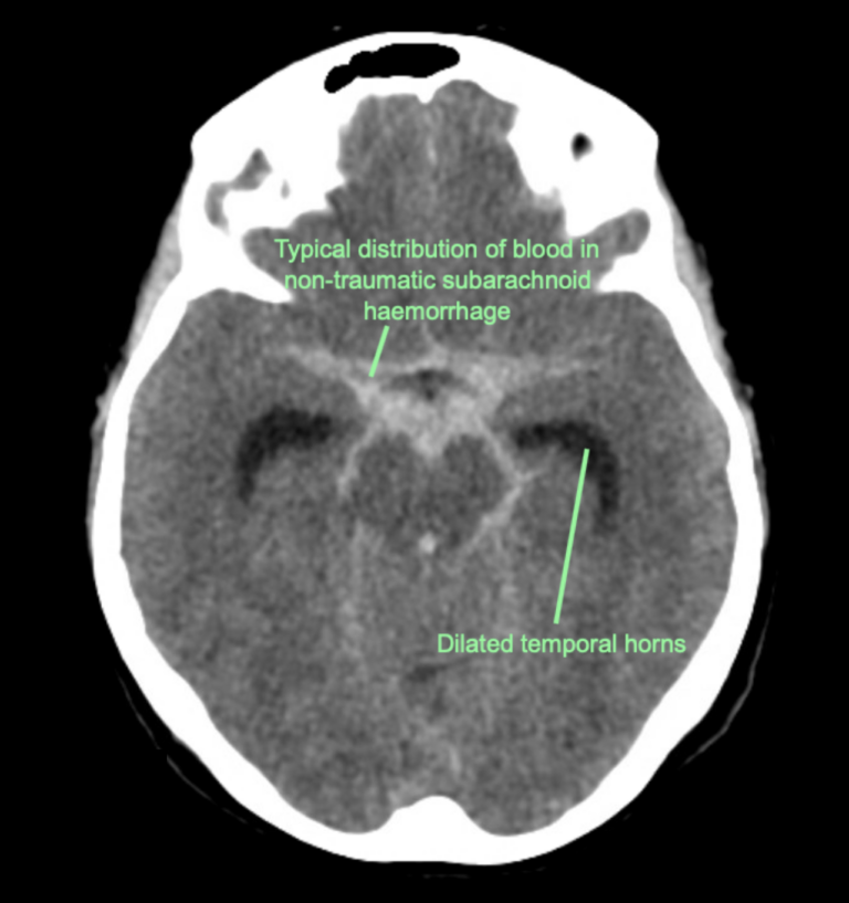 CT Case 016 • LITFL • CT scan interpretation