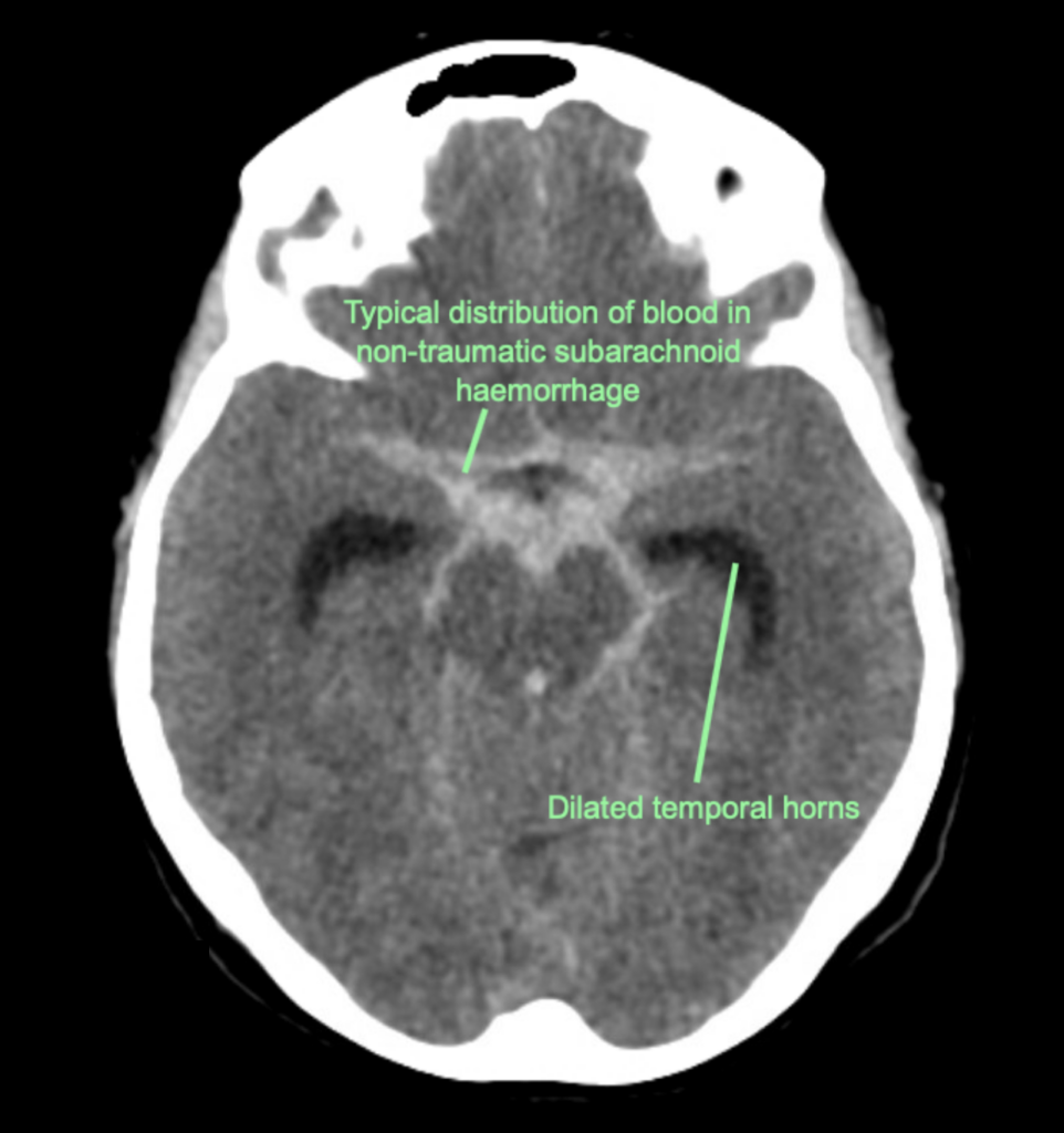CT Case 016 LITFL CT Scan Interpretation