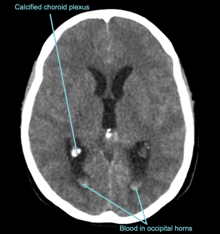 CT Case 016 • LITFL • CT scan interpretation