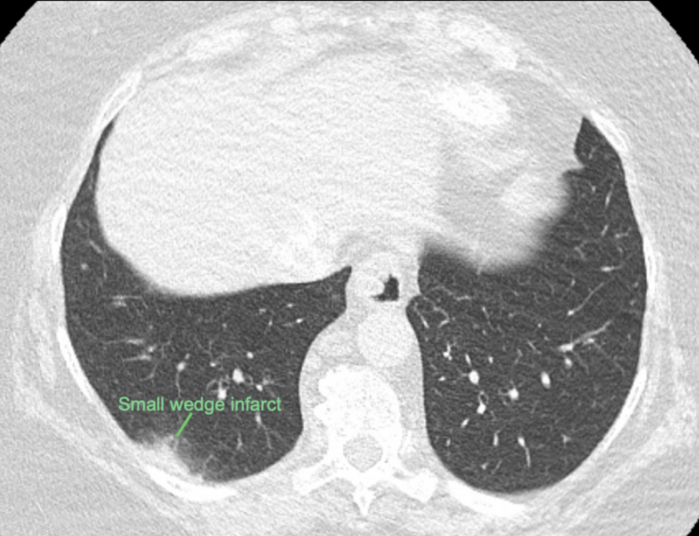 CT Case 009 • LITFL • CT scan interpretation