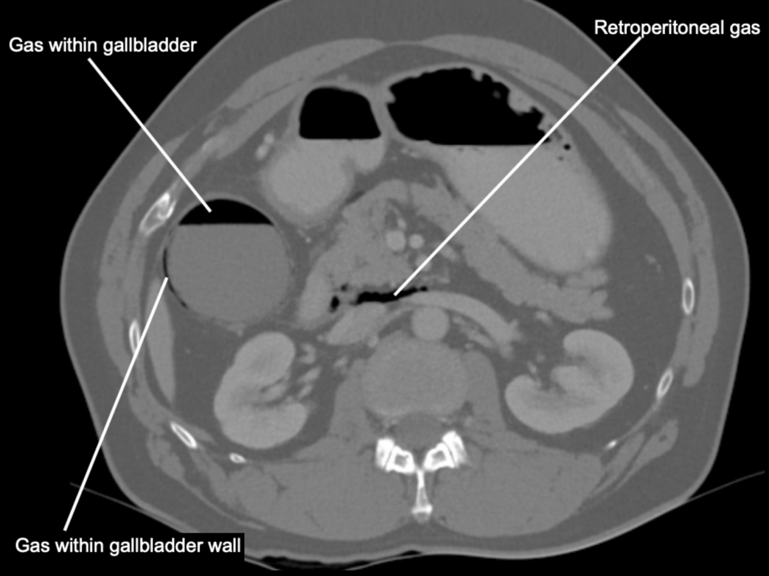 CT Case 010 • LITFL • CT scan interpretation