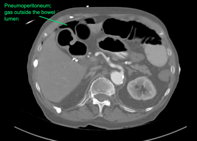 CT Case 012 • LITFL • CT scan interpretation