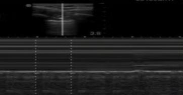 POCUS Made Easy: Lung • LITFL • Ultrasound Library