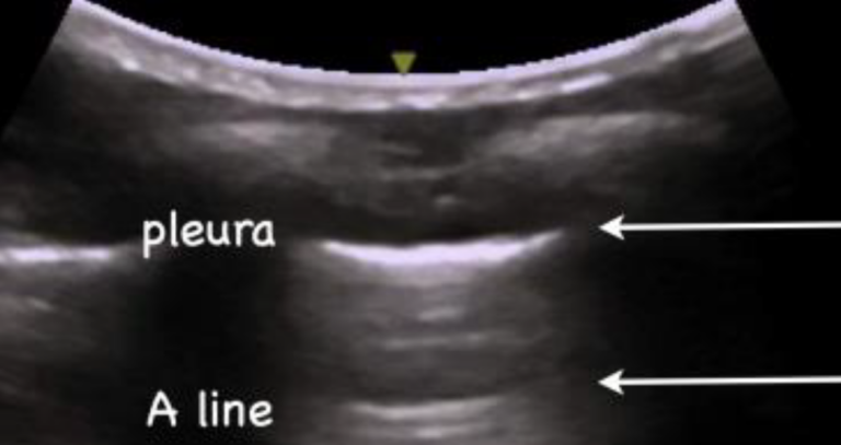 POCUS Made Easy: Lung • LITFL • Ultrasound Library