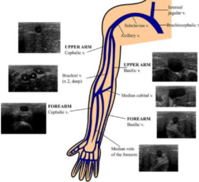 Ultrasound Guided Vascular Access • LITFL • Ultrasound Library