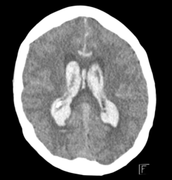 CT Case 018 • LITFL • CT scan interpretation