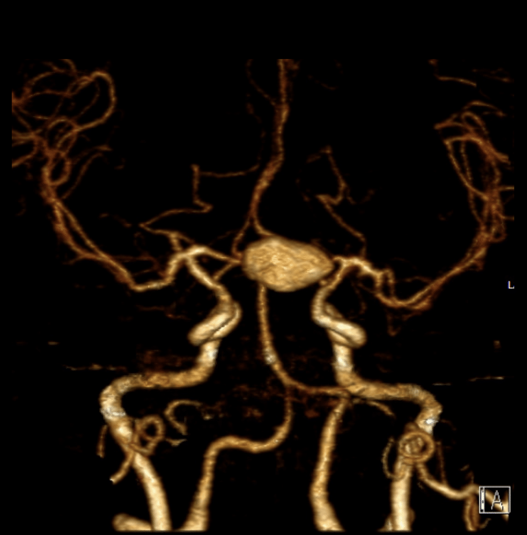 CT Case 018 • LITFL • CT scan interpretation