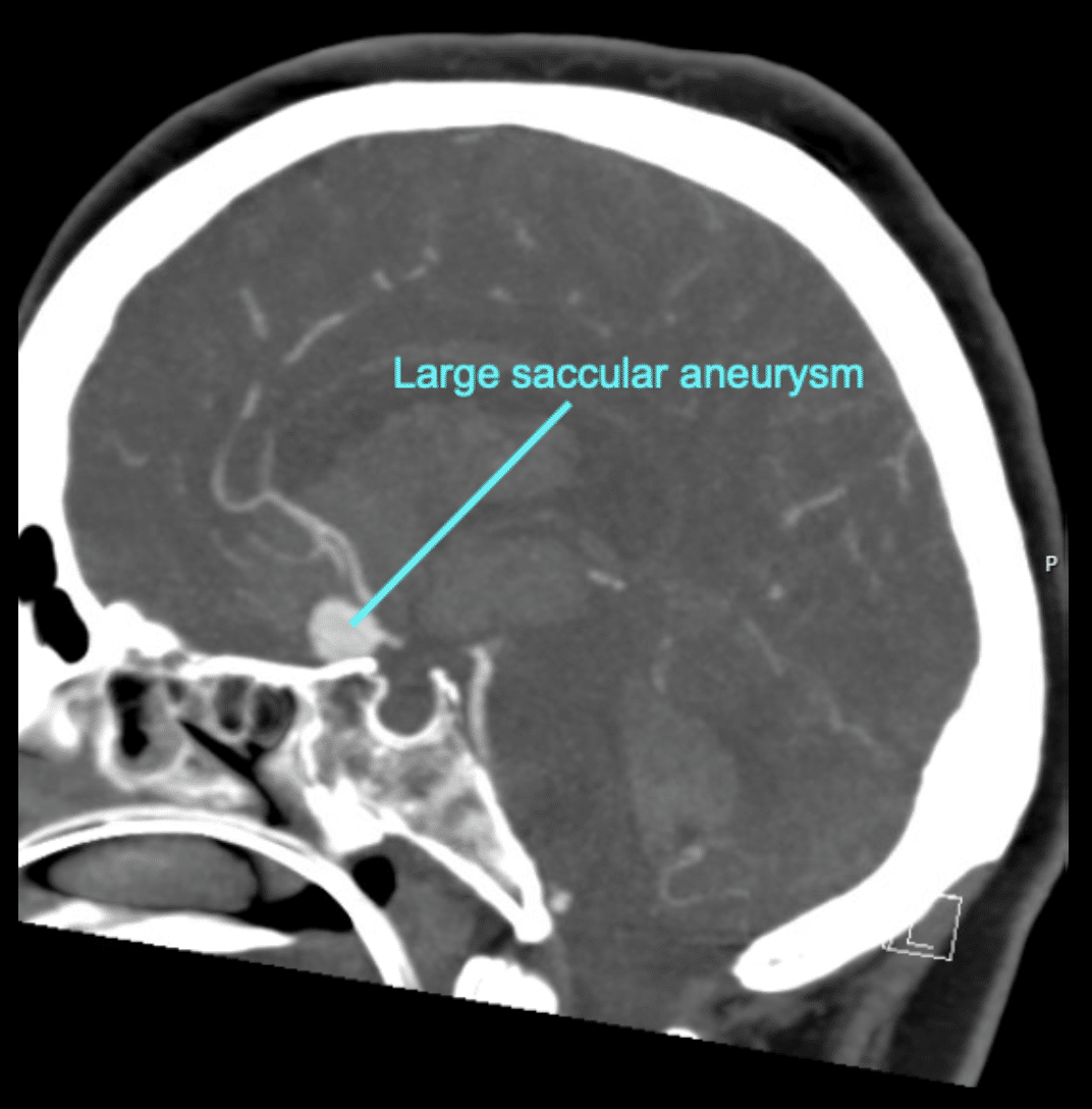 CT Case 018 • LITFL • CT scan interpretation