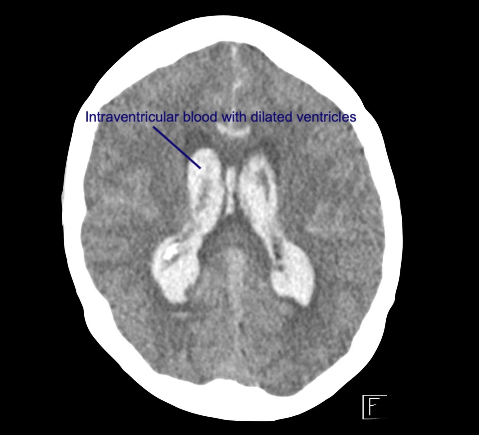 CT Case 018 • LITFL • CT scan interpretation