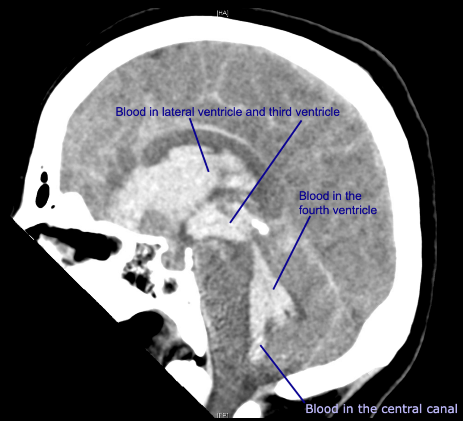 CT Case 018 • LITFL • CT scan interpretation