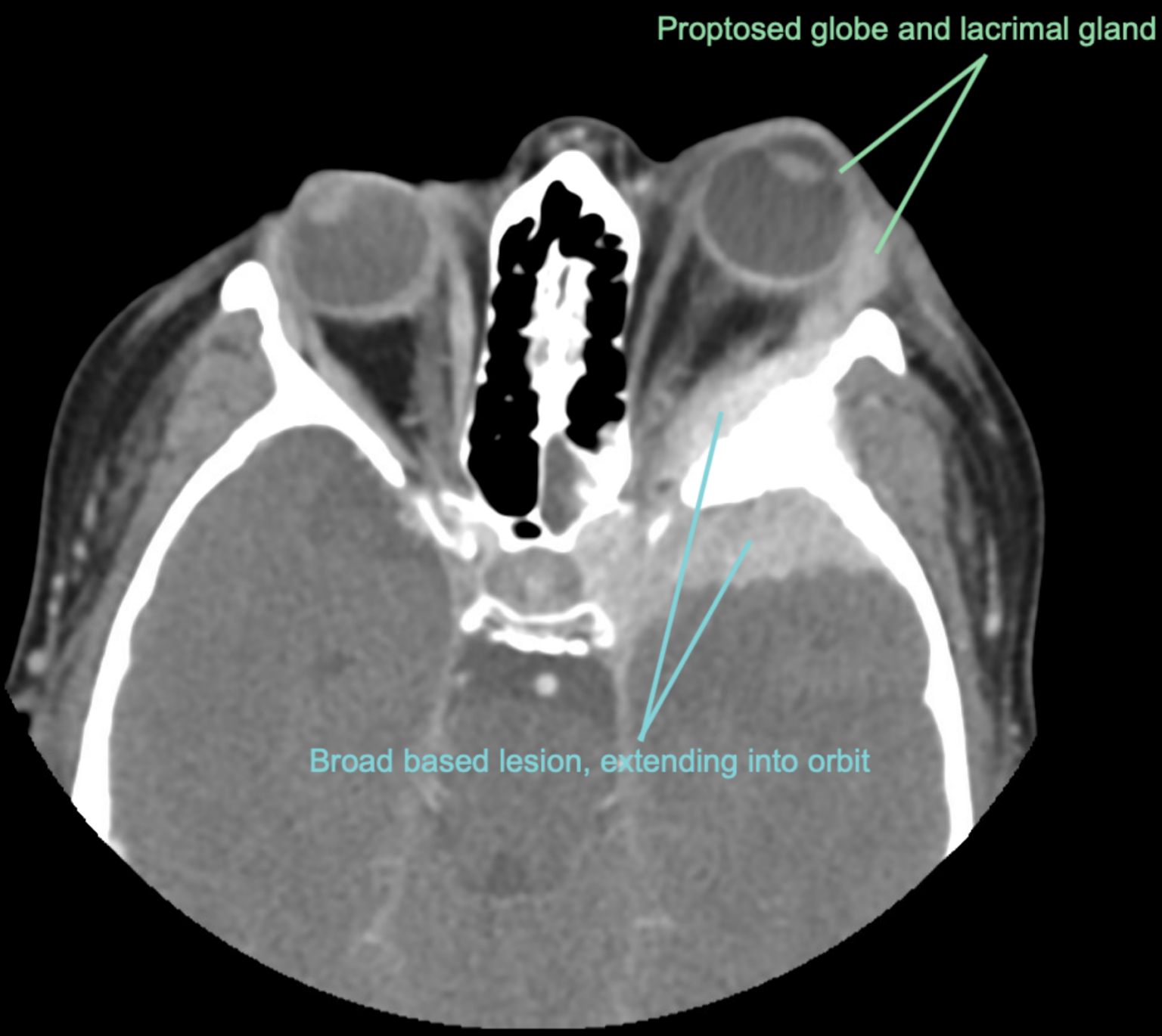 CT Case 019 • LITFL • CT scan interpretation