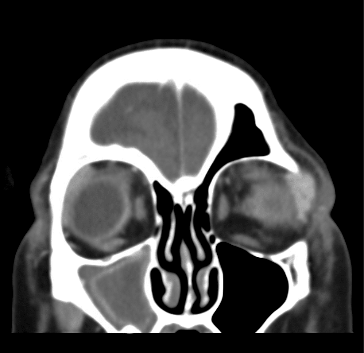 CT Case 019 LITFL CT Scan Interpretation