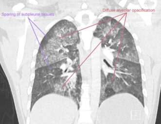 Cardiogenic Pulmonary Edema Ct – Pulmonary Edema – DYKOT