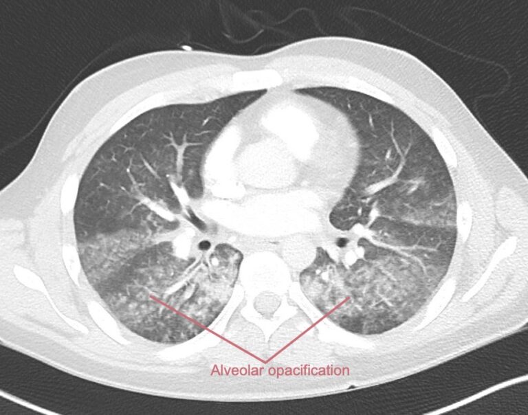 CT Case 028 • LITFL • CT scan interpretation