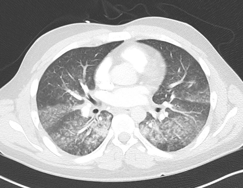CT Case 028 LITFL CT Scan Interpretation CT Case 028 LITFL CT Scan Interpretation