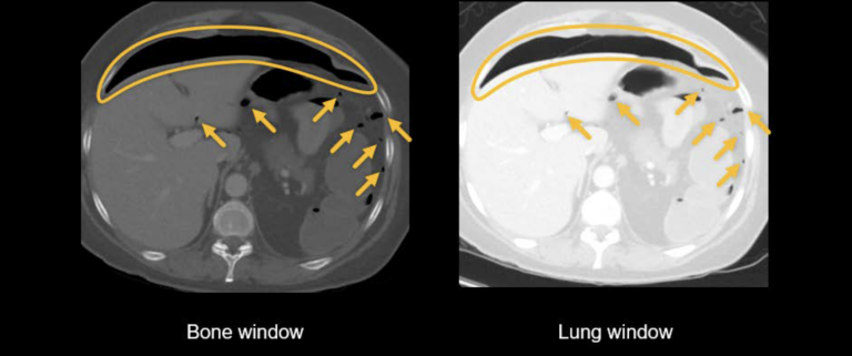 Abdominal CT: bowel perforation • LITFL • Radiology Library