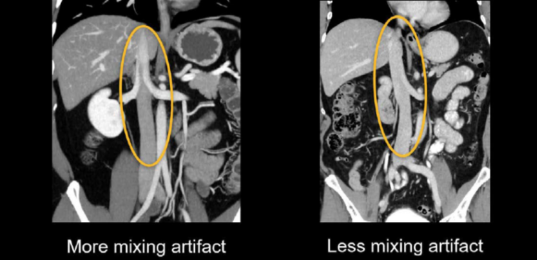 Abdominal Ct Abdominal Veins • Litfl • Radiology Library